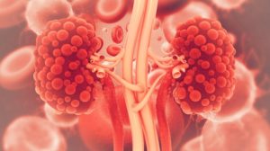 Uremia: Definition, Causes, Symptoms and Treatments - Scope Heal