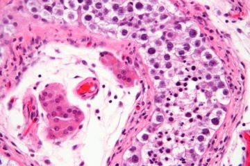 What is a Neoplasia: Examples, Types and Causes - Scope Heal