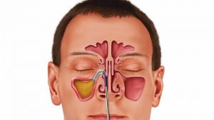 Sinusitis: Paranasal Sinuses, Symptoms, Causes, Risk Factors, Types ...
