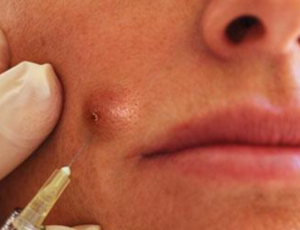 Epidermoid Cyst: Causes, Diagnosis, Symptoms, Treatment, Risk Factors ...