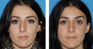 Deviated Septum: Causes, Symptoms, Diagnosis, Treatment, Recovery and ...