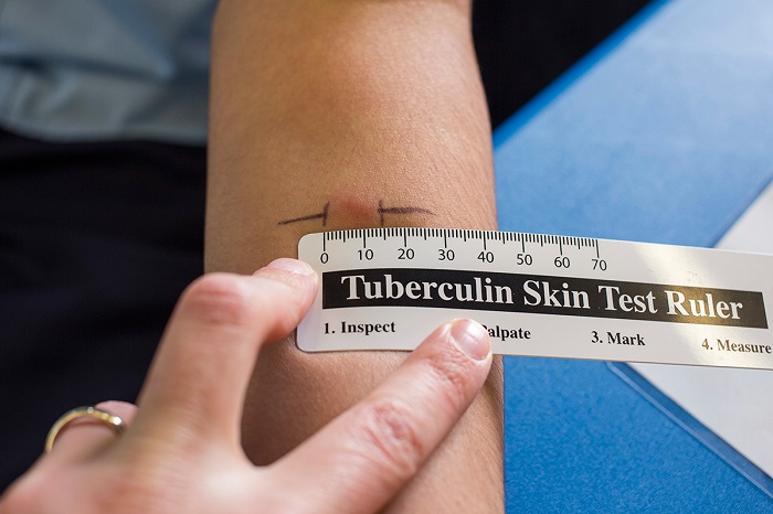 Tuberculin: Medical Uses, History, Dosage, Reading Method ...