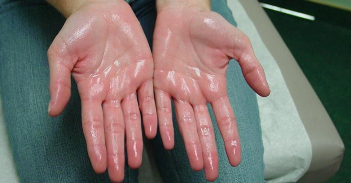 Simpatectomy - Definitive Treatment for Excessive Sweating: Risks and ...