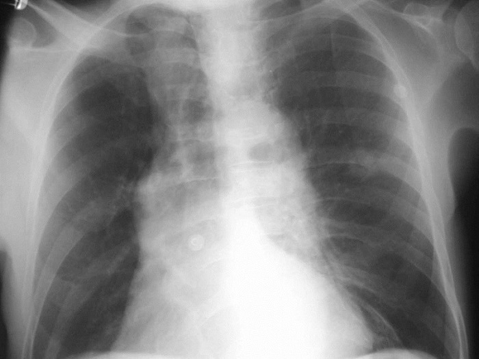Pulmonary Nodule: Symptoms, Causes, Diagnosis and Treatment - Scope Heal