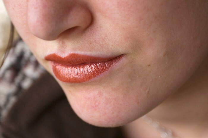 Erythema Nodosum: Its Symptoms, Causes and Treatment - Scope Heal