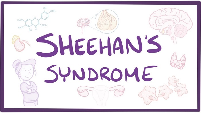 Sheehan Syndrome: Definition, Causes, Risk Factors, Symptoms, Diagnosis ...