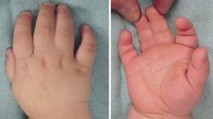 Syndactyly: Definition, Causes, Forms, Symptoms, Diagnosis, Treatment ...