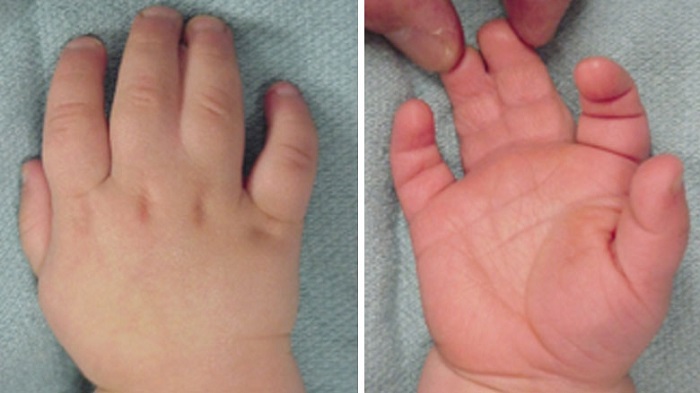 Syndactyly: Definition, Causes, Forms, Symptoms, Diagnosis, Treatment ...