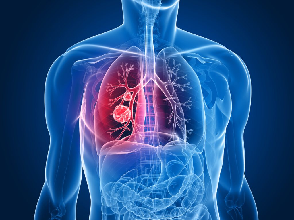 Pulmonary Metastasis: Causes, Frequency, Mortality, Clinical Details ...